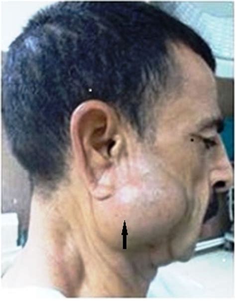 Swollen Parotid Lymph Node Swollen Parotid Lymph Node