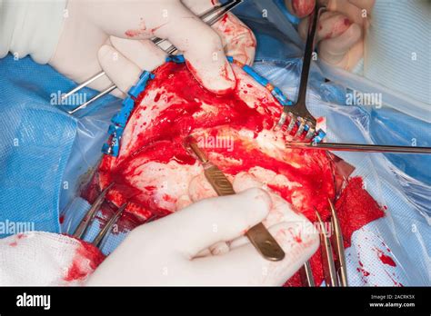 Craniotomy Brain Surgery Surgeon Using Tools To Peel Back And Hold In
