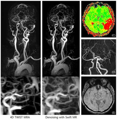 Deep Learning Based High Resolution Magnetic Resonance Angiography Mra