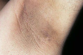 Acanthosis Nigricans Nhs