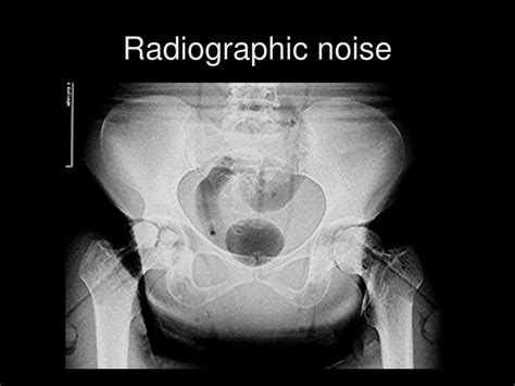Radiographic Mottle At Emma Rouse Blog