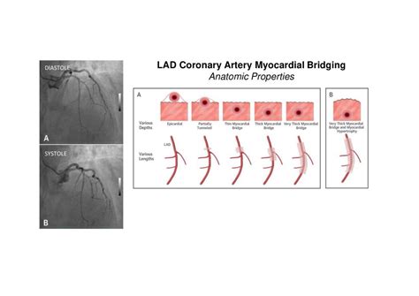 Left Anterior Descending Artery Myocardial Bridging Ppt Download