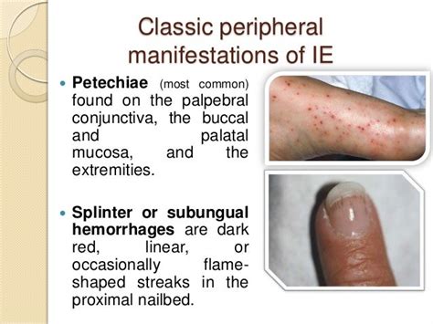Infective Endocarditis
