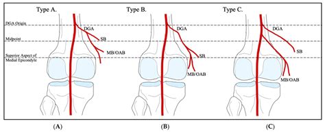 Genicular Artery Embolization A Technical Review Of Anatomy