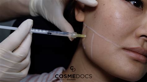 Masseter Botox