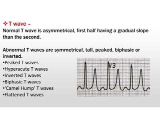 Ecg Understanding And Interpretation Pdf