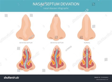 Septum Anatomy Over 2 356 Royalty Free Licensable Stock Illustrations
