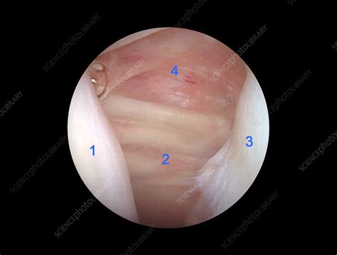 Normal Shoulder Joint Endoscope Image Stock Image C026 9070 Science Photo Library