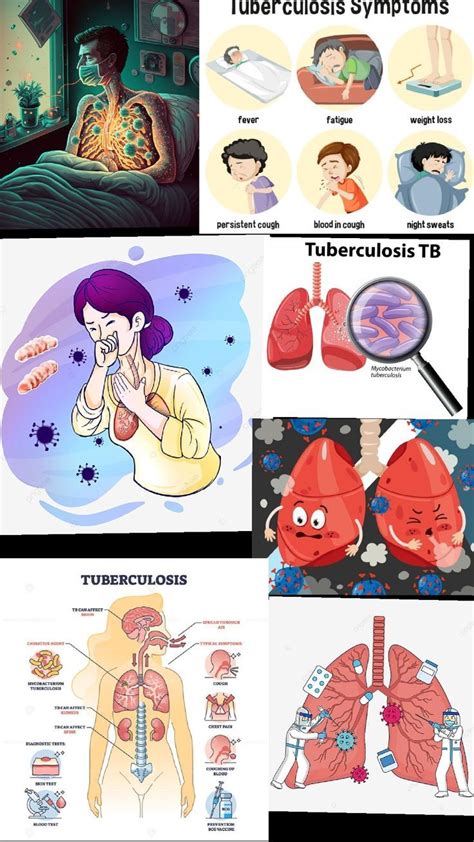 Pin En Tueberculosis