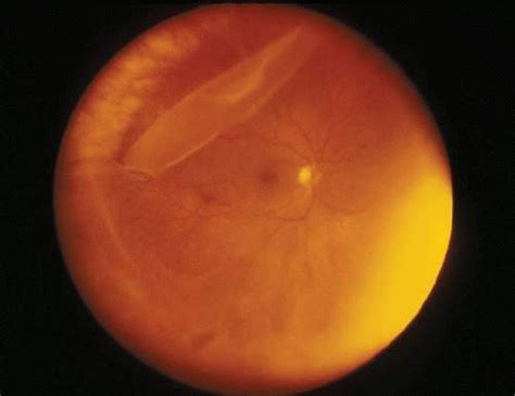 Giant Retinal Tears Surgical Approach Ento Key