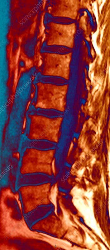 Spondylosis Deformans Mri Scan Stock Image C0215443 Science Photo Library