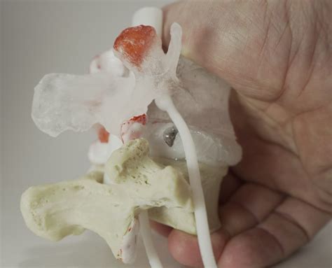 Far Lateral Lumbar Disc Herniation Visualizing With A Lumbar Model