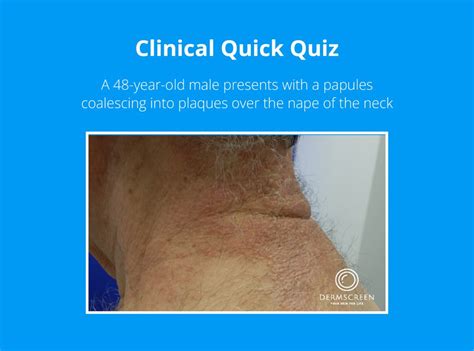 Clinical Quick Quiz What Is The Most Likely Diagnosis For Papules