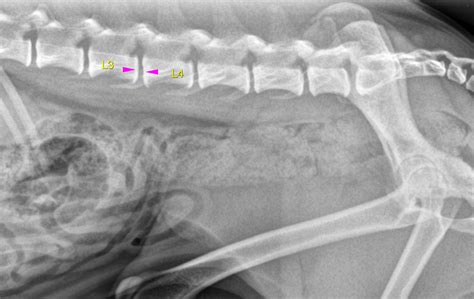 Rad Normal Pelvis With Mild Disc Space Narrowing In A 7 Year Old Fs