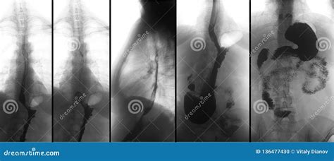 Upper Gi Endoscopy Hiatal Hernia At Karen Watts Blog
