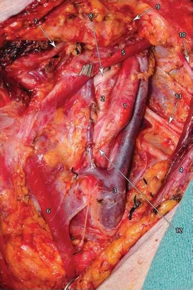 Salvage Neck Dissection Indications Workup And Technical Considerations Neck Surgery