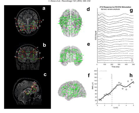 Figure 1 From A Connectomics Approach Combining Structural And Effective Connectivity Assessed