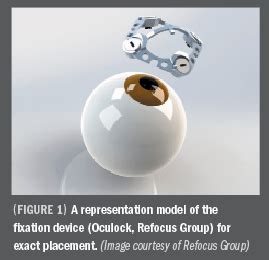 Refocus Scleral Implants For Presbyopia