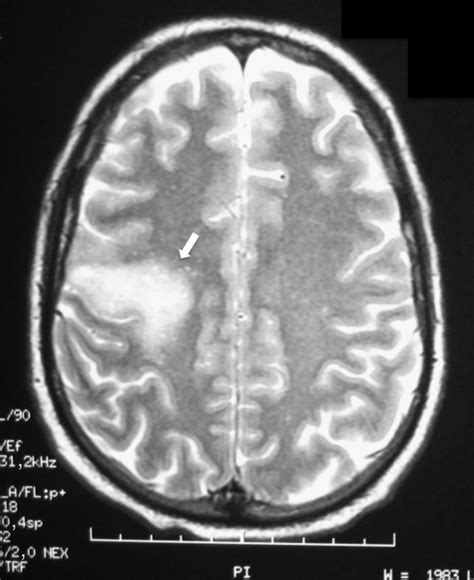 Leucoencefalopatia Multifocal Progressiva Leucoencefalopatia