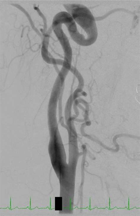 Fibromuscular Dysplasia State Of The Science And Critical Unanswered