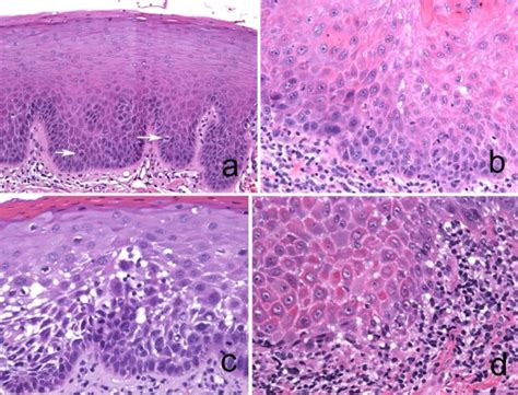 Oral Epithelial Dysplasia Atypical Verrucous Lesions And Oral