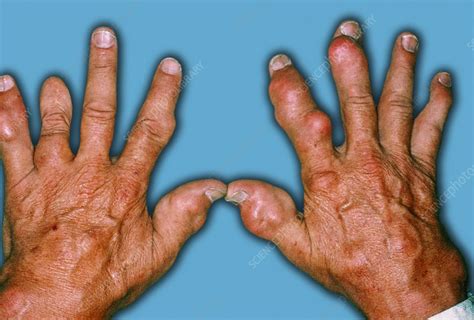 Gout Stock Image M Science Photo Library
