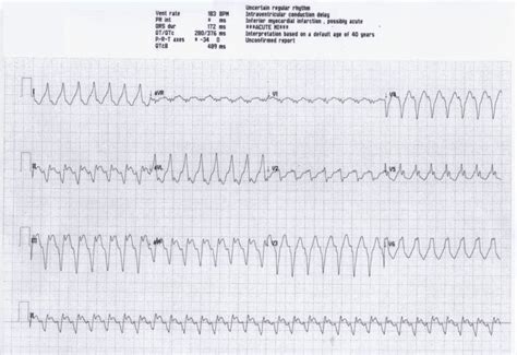 EM Cases ECG Cases 19 Tachycardias