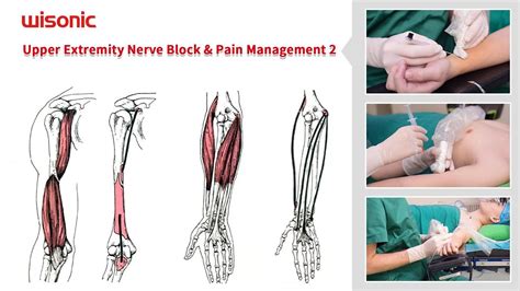 Upper Extremity Nerve Blocks Ppt At Kimberly Clifton Blog