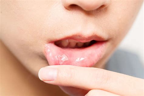 Sore Tongue 10 Causes Of A Sore Tongue