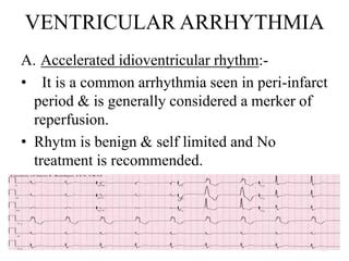 Complications Of Acute Coronary Syndrome And Its Managementpptx