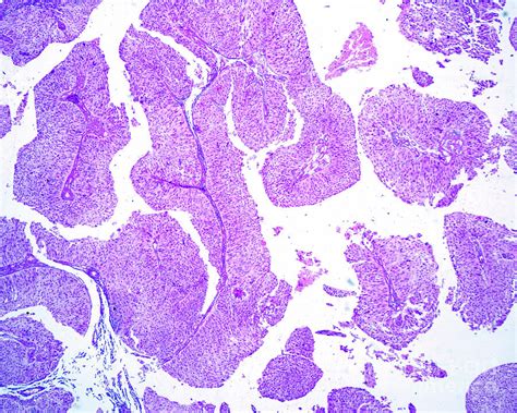 Urinary Bladder Papilloma By Jose Calvo Science Photo Library