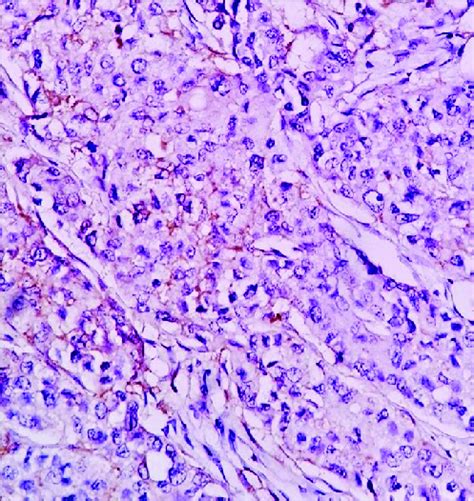Low Expression Of Claudin 4 In Tumoral Cells Original Magnification×40