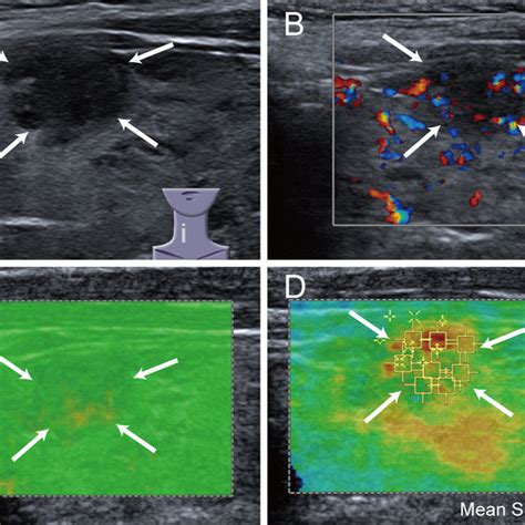 The Flowchart Of Thyroid Nodule Selection Download Scientific Diagram