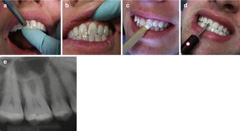 Classification Of Pulpal And Peri Apical Disease Pocket Dentistry