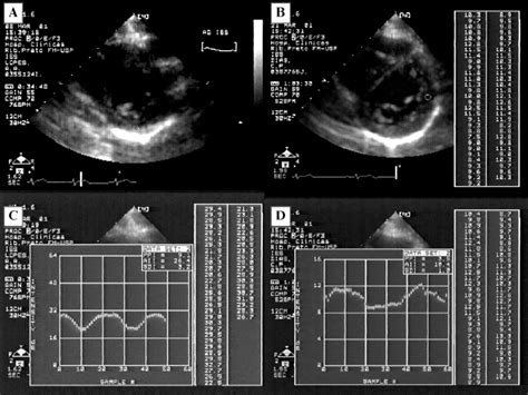 A E B Exemplos De Uma Projeção Do Ventrículo Esquerdo No Eixo Curto Download Scientific