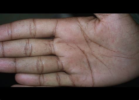 Palmar Pits And Epidermodysplasia Verruciformis A Rare Association Indian Journal Of