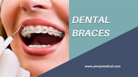 Dental Braces Price In The Philippines 2026 — Pinoymedical