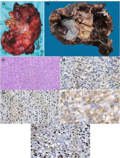 3a Left Nephrectomy Specimen Shows The Irregular Contour Of The Outer