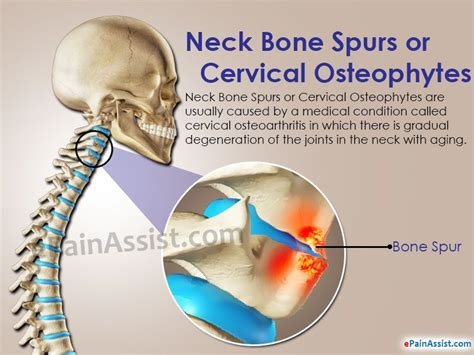 What Is A Bone Spur On Collar Bone At Levi Skipper Blog