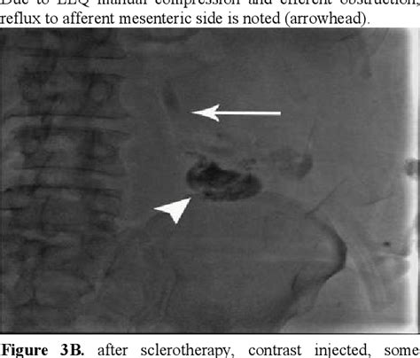 Figure 3 From Intractable Parastomal Bleeding In A Portal Hypertensive