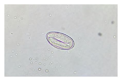Enterobius Vermicularis Ova Ectopic Enterobiasis A Case Report And