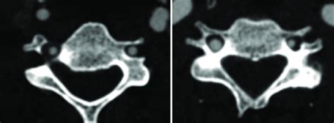 A Cta Showing Vertebral Artery Located In The Medial Part Of Download Scientific Diagram