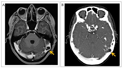 Giant Arachnoid Granulations A Systematic Literature Review