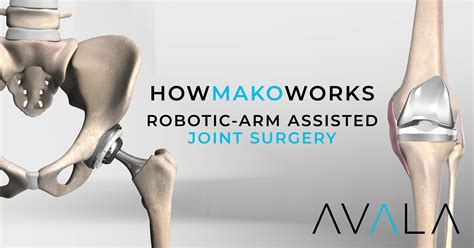 How Mako Robotic Arm Assisted Surgery Works