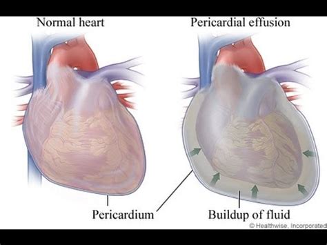 My Pericarditis Or Heart Fluid Buildup I Think It Was Caused By An