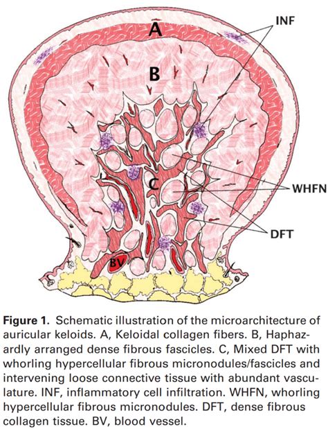 Whats Inside Keloids How It Affects Keloid Removal 1aesthetics