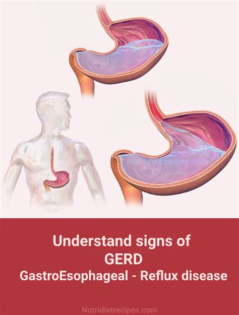 Understand Signs 0f Gerd Reflux Disease Nutri Diet Recipes