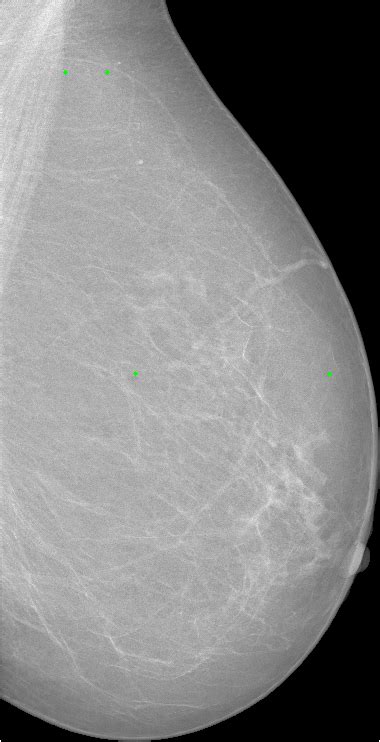 10 Examples Of Calcification Detection Green Dots Correspond To Tps Download Scientific