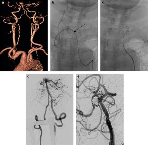 An 82 Year Old Woman With A Right Superior Cerebellar Artery Sca