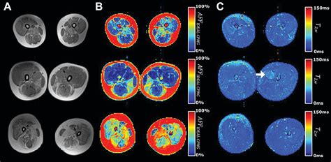 Muscle Steatosis And Fibrosis In Older Adults From The Ajr Special